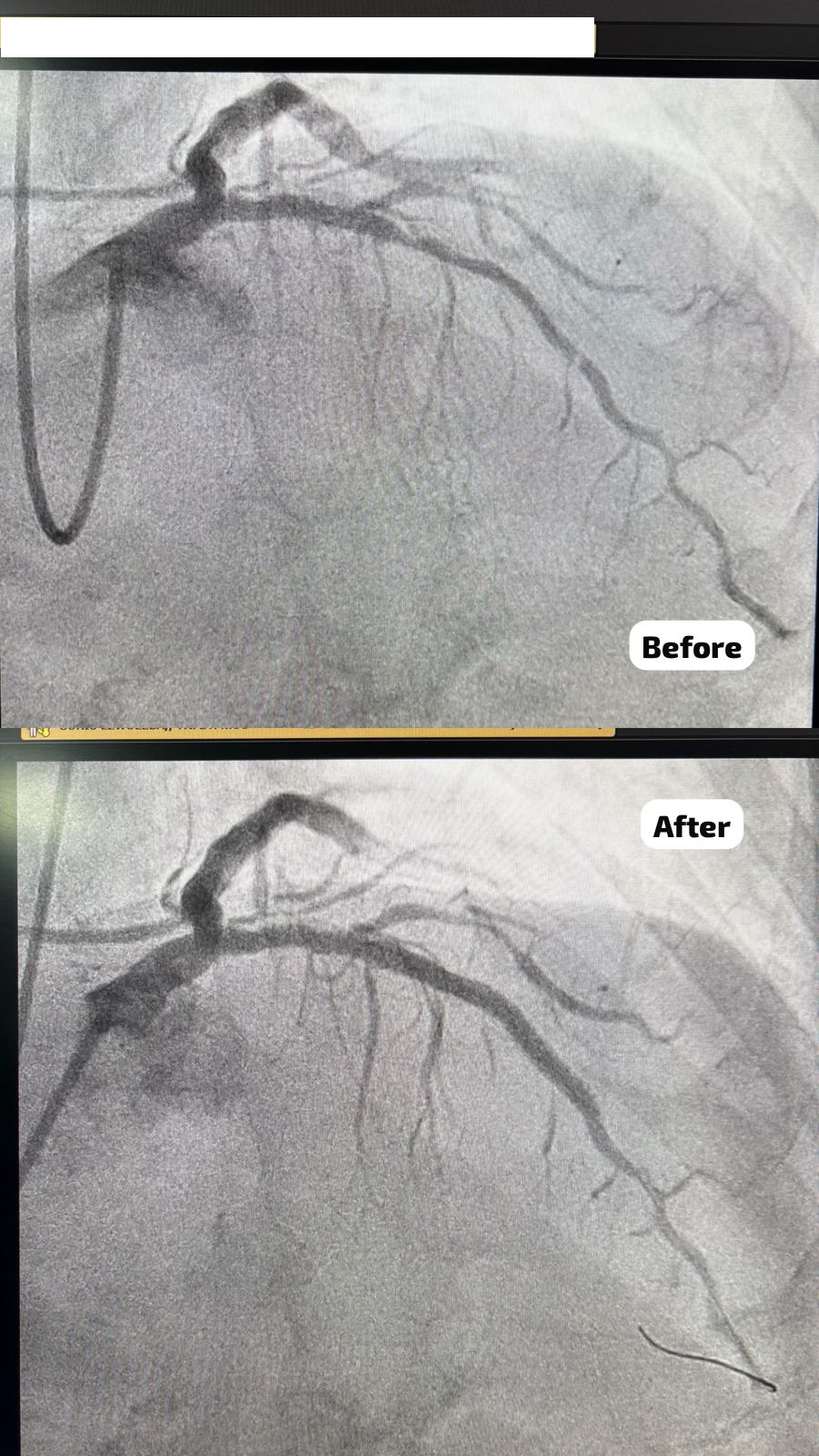 Intravascular lithotripsy (IVL) treatment for ISR at RSJPD Harapan Kita ...