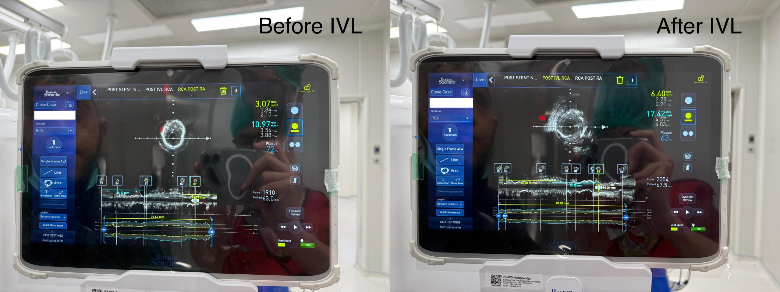 Intravascular lithotripsy (IVL) treatment for a CTO condition at RSJPD ...