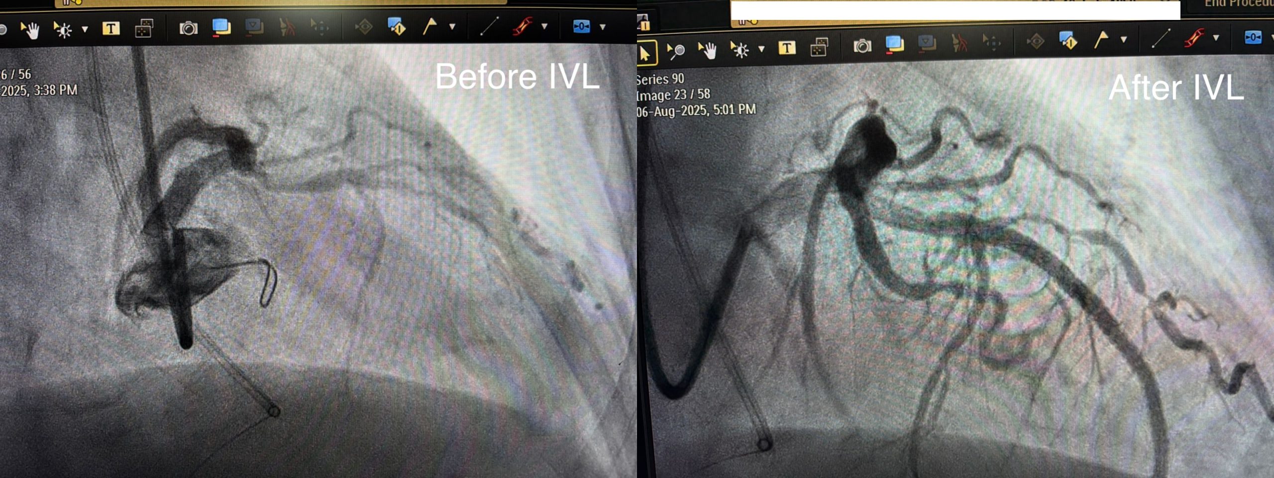 Intravascular lithotripsy (IVL) for near-CTO condition at RSJPD Harapan ...